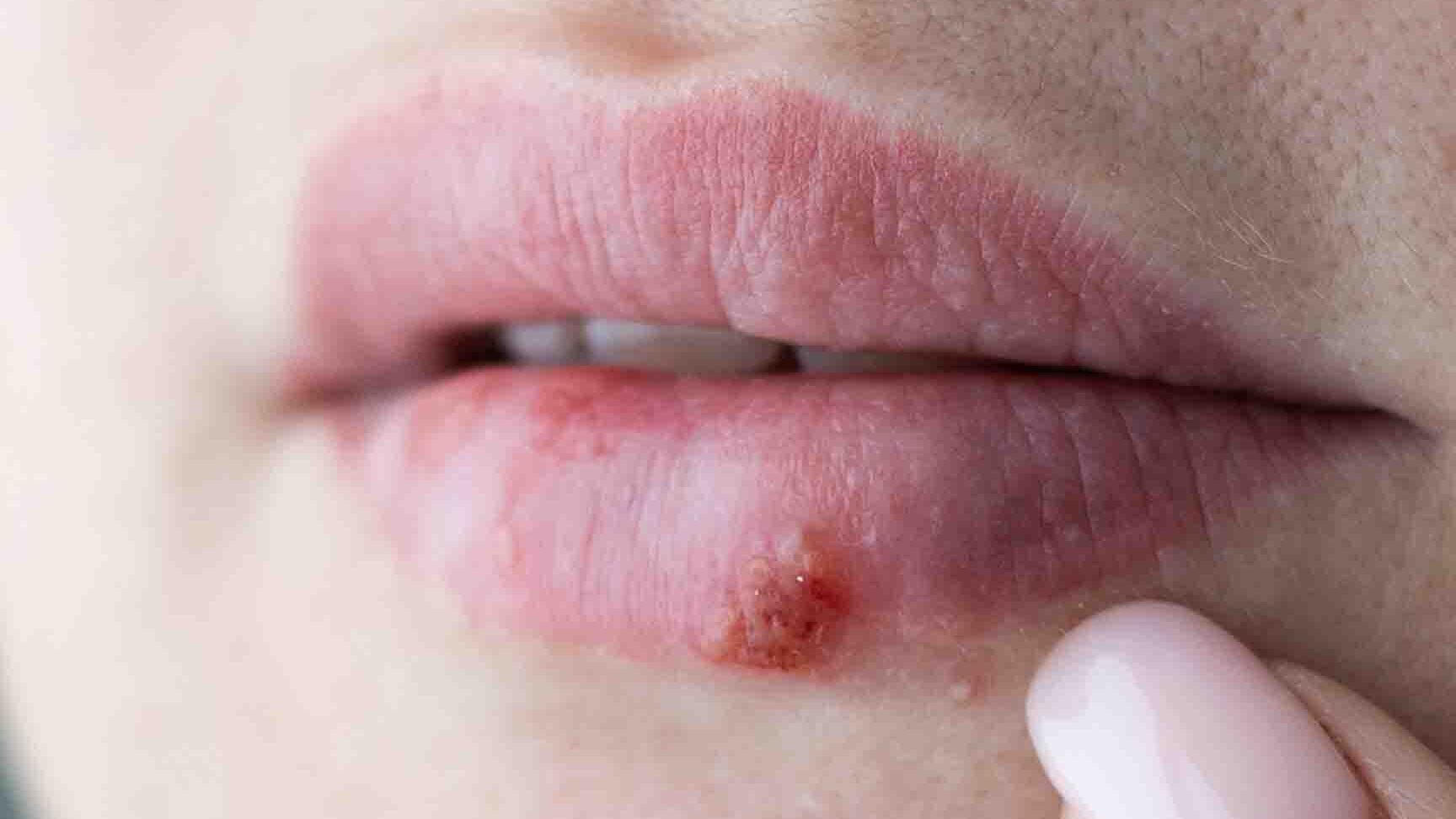 Éruption cutanée : symptômes et solutions pour soulager » Nuisibles Expert