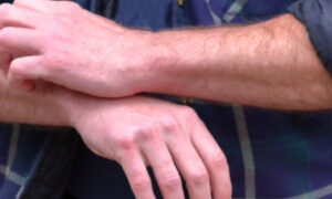 Puces sur humain : conseils efficaces pour éliminer ces nuisibles ...